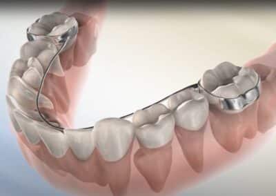 Appliance Care - True North Orthodontics