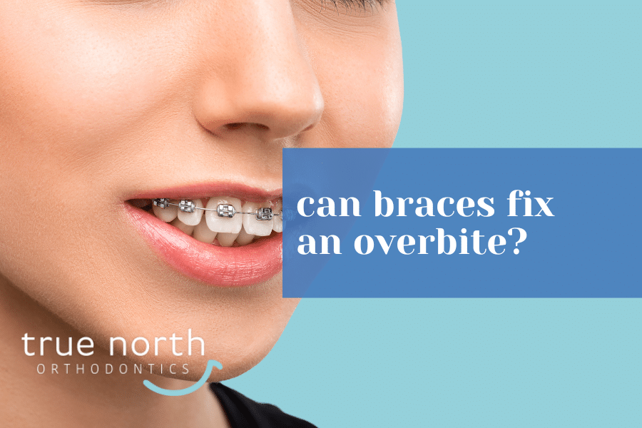 Will braces fix an overbite? - True North Orthodontics
